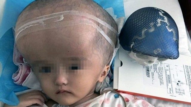 The first transplant of a skull printed in 3D format has been done ...