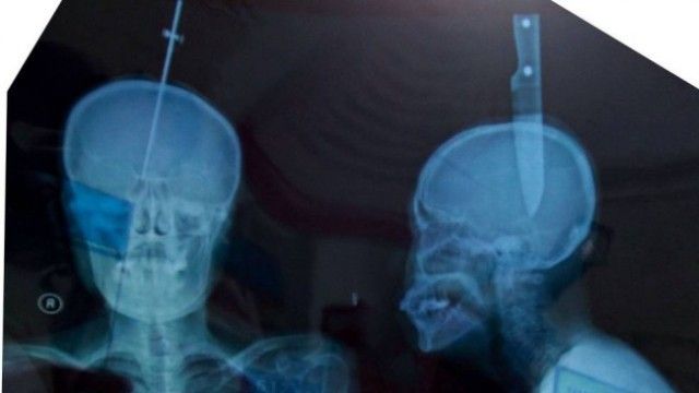 Shpëton pasi i nxjerrin thikën nga koka - Telegrafi