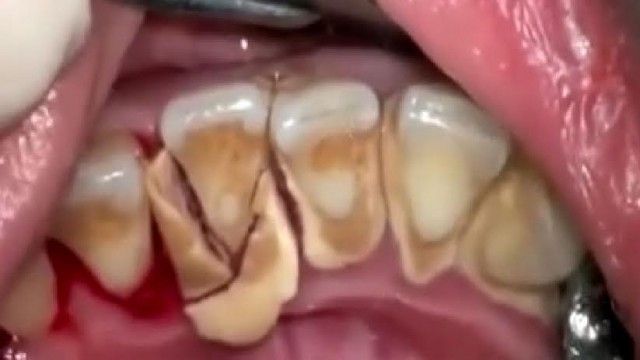 This disgusting video shows why you should brush your teeth every day ...