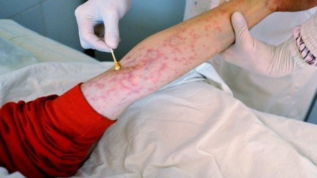 In Kosovo, 27 people identified with HIV/AIDS - Telegrafi - Telegrafi