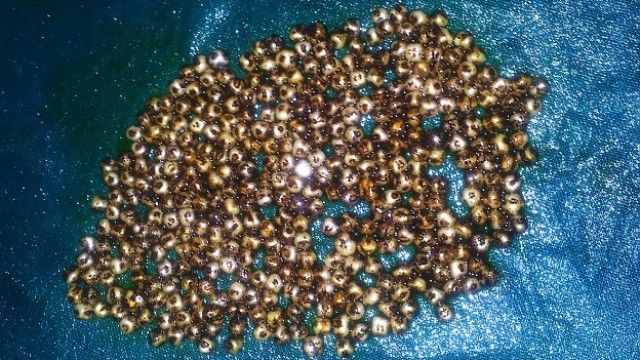 Shokohen mjekët, pasi i nxjerrin 360 gurë nga tëmthi - Telegrafi ...