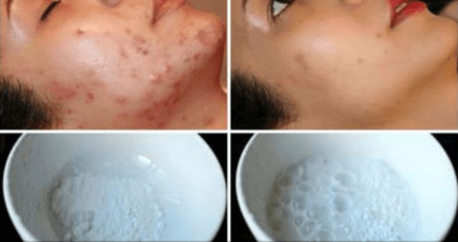 The natural product that magically removes marks, acne and wrinkles ...