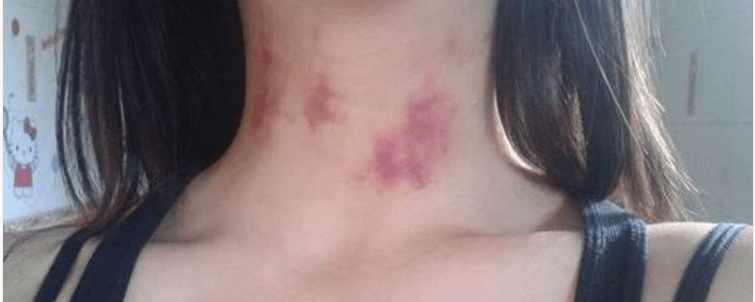 "Love bites" or the marks on the neck, appear as a result of the lack ...