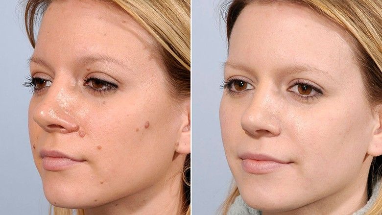 Me këtë përbërës të thjeshtë mund t'i hiqni lythat - Telegrafi - Telegrafi