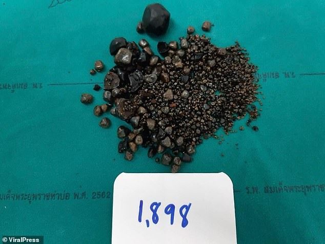 Tronditen mjekët tajlandezë, nxjerrin nga stomaku i gruaje 1.898 gurë ...