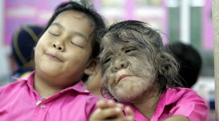 They received contaminated medicine, 16 children in Spain are affected ...