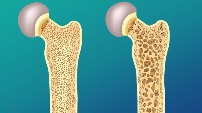 Osteoporoza dhe marramendja - Telegrafi - Telegrafi