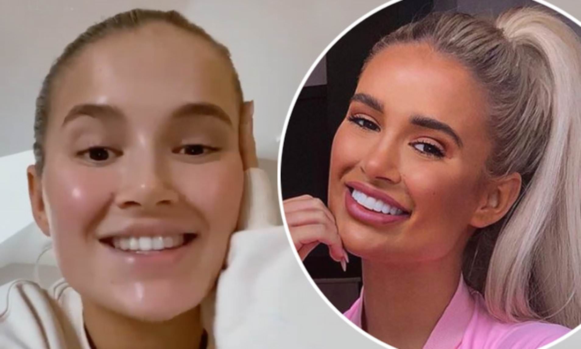 Molly Mae opens up about 'extremely yellow' teeth and her insecurities ...