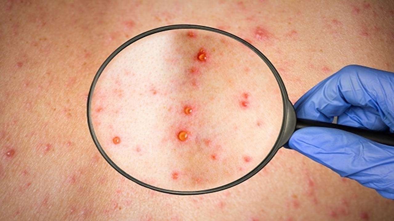 Health officials: Monkey pox could become endemic in Europe - Telegraph ...