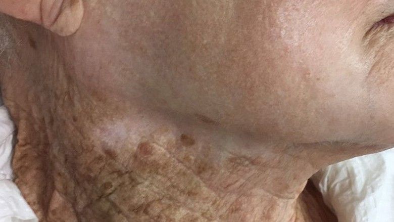 Dyzet vjet ka lyer fytyrën me krem për rrezitje, por jo edhe qafën ...