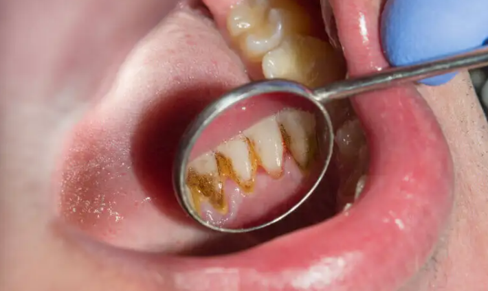 Ju formohen gurët e zi në dhëmbë? Si t’i largoni dhe si mund të ...