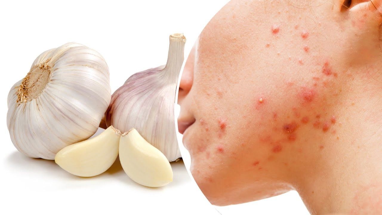 Can we treat acne with raw garlic? What do the experts say - Telegraph ...