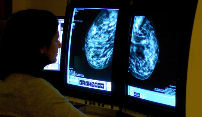 New test with Artificial Intelligence can detect breast cancer in the ...