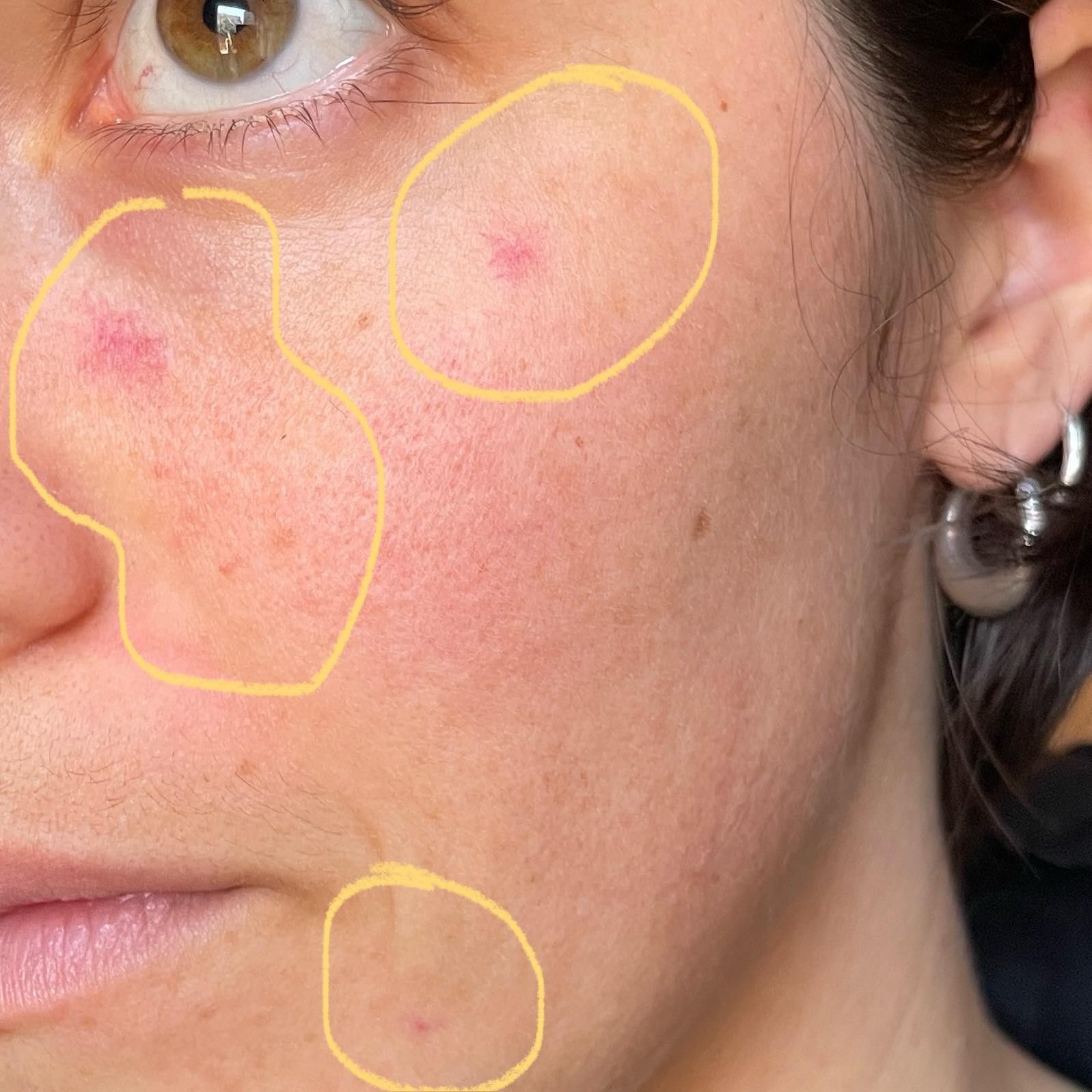 Më shumë se tre dukuri në formë merimange në lëkurë kërkojnë kontroll ...