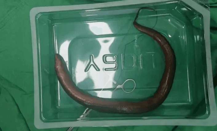 Mjekët zbulojnë një gjarpër të gjallë duke notuar në barkun e një ...